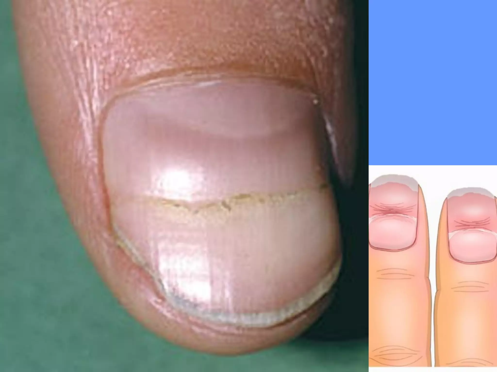 Nail disorder - Dr Aisha Almoosa | PDF | Skin and Dermatology ...