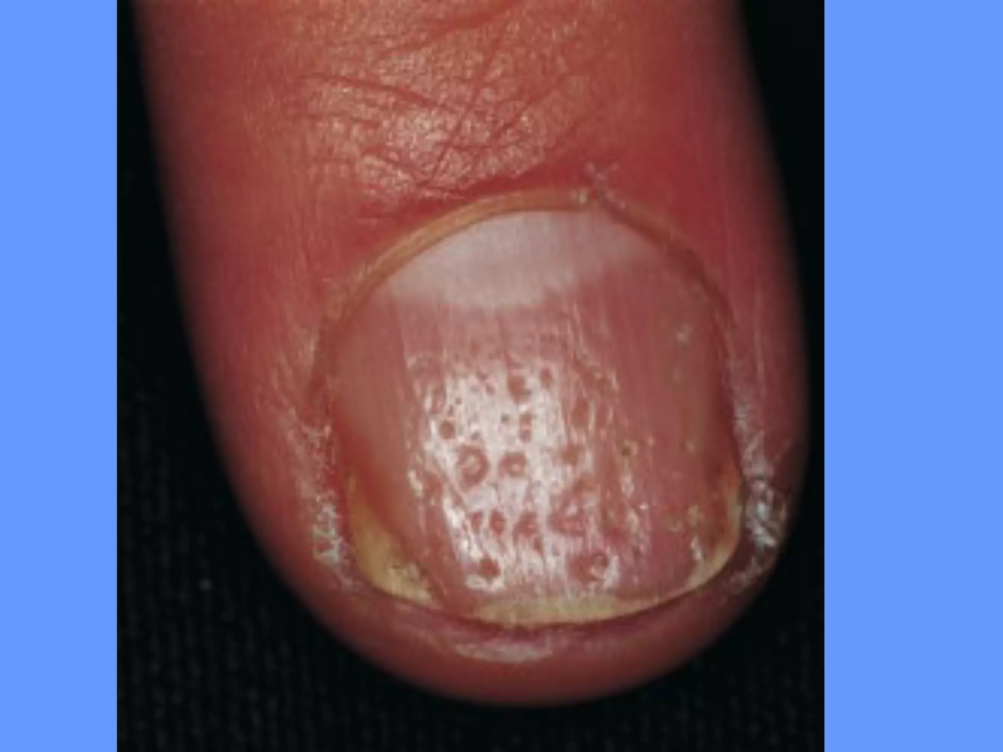 Nail disorder - Dr Aisha Almoosa | PDF | Skin and Dermatology ...