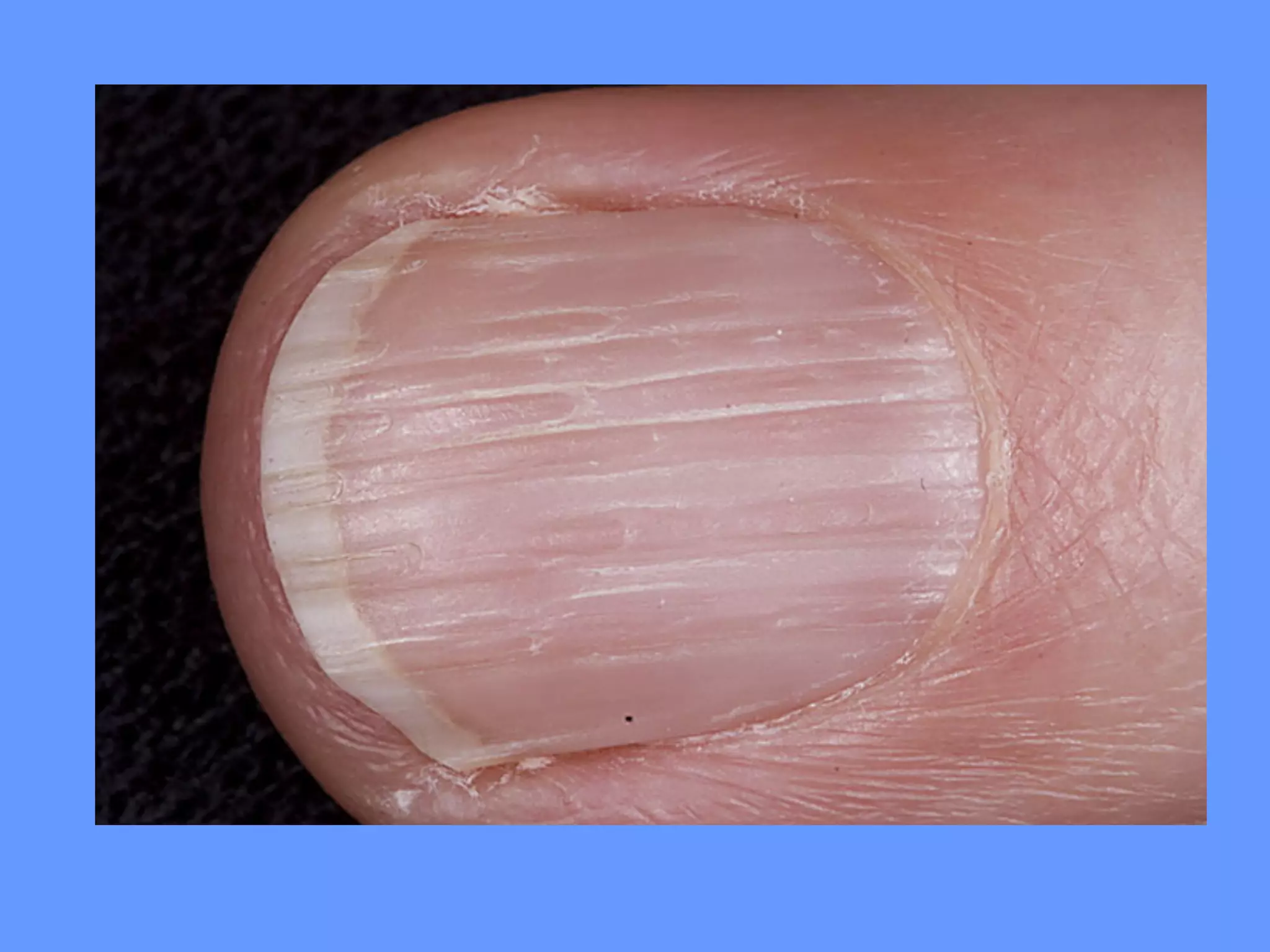 Nail disorder - Dr Aisha Almoosa | PDF | Skin and Dermatology ...