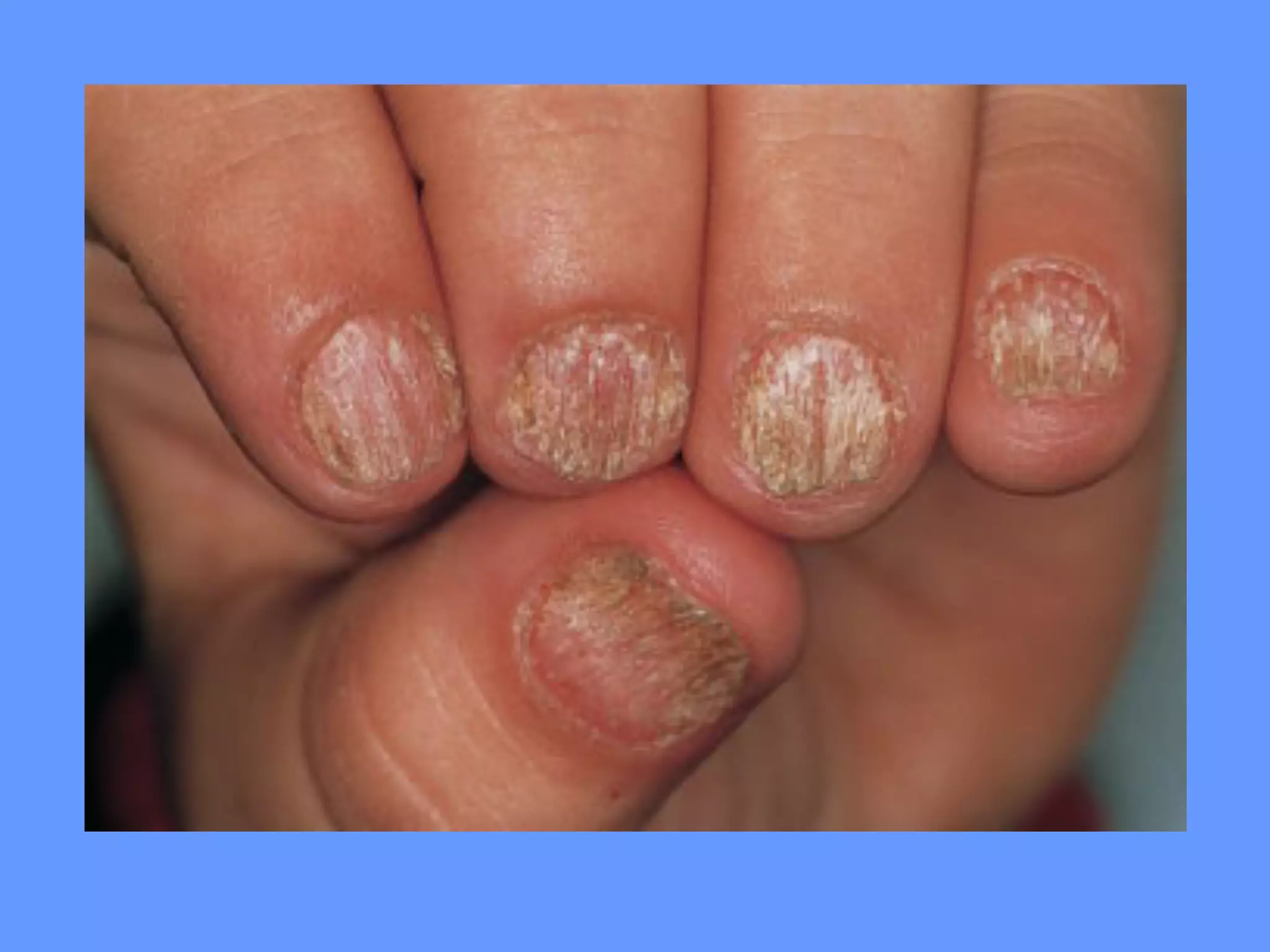 Nail disorder - Dr Aisha Almoosa | PDF | Skin and Dermatology ...