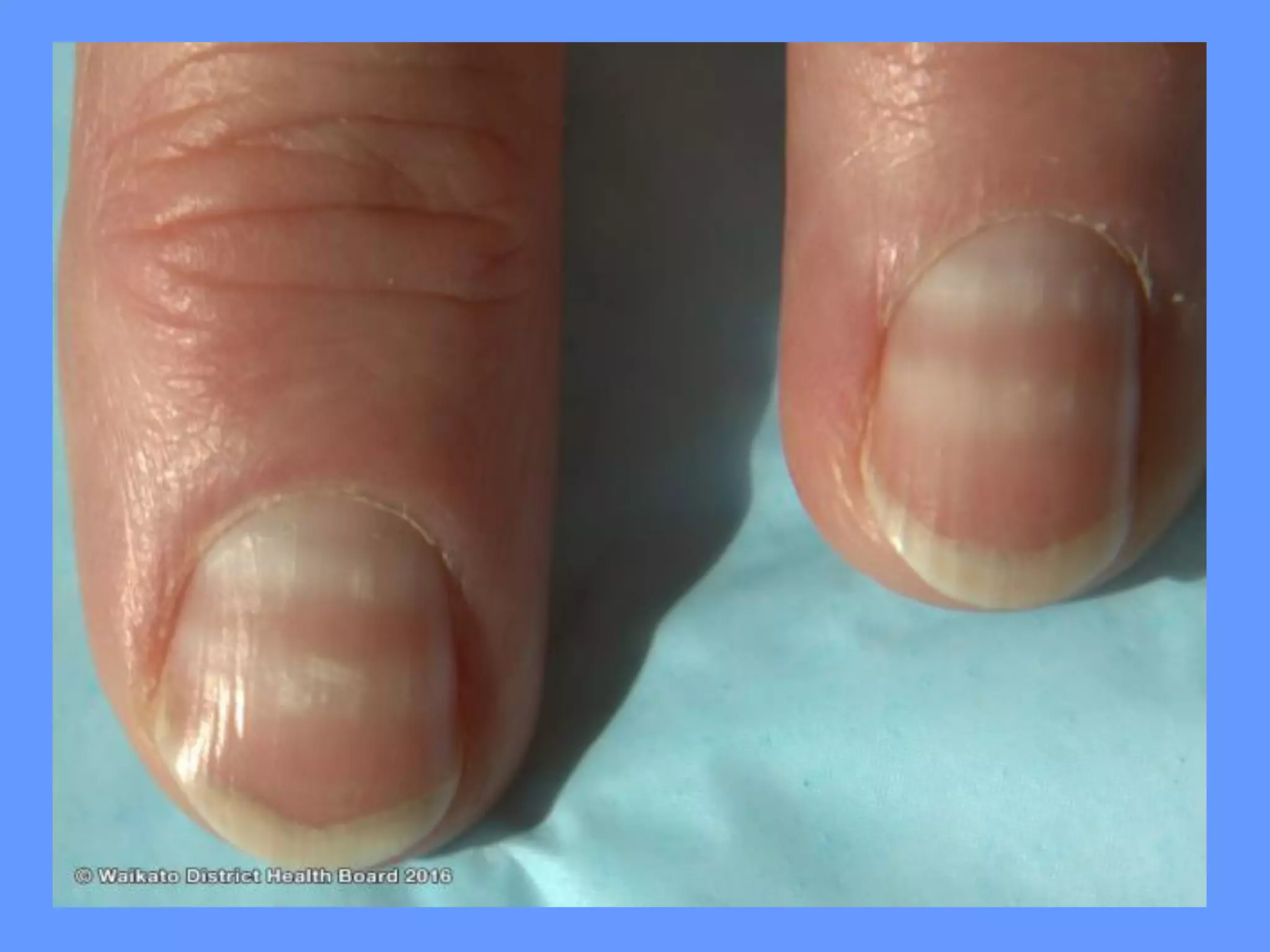 Nail disorder - Dr Aisha Almoosa | PDF | Skin and Dermatology ...