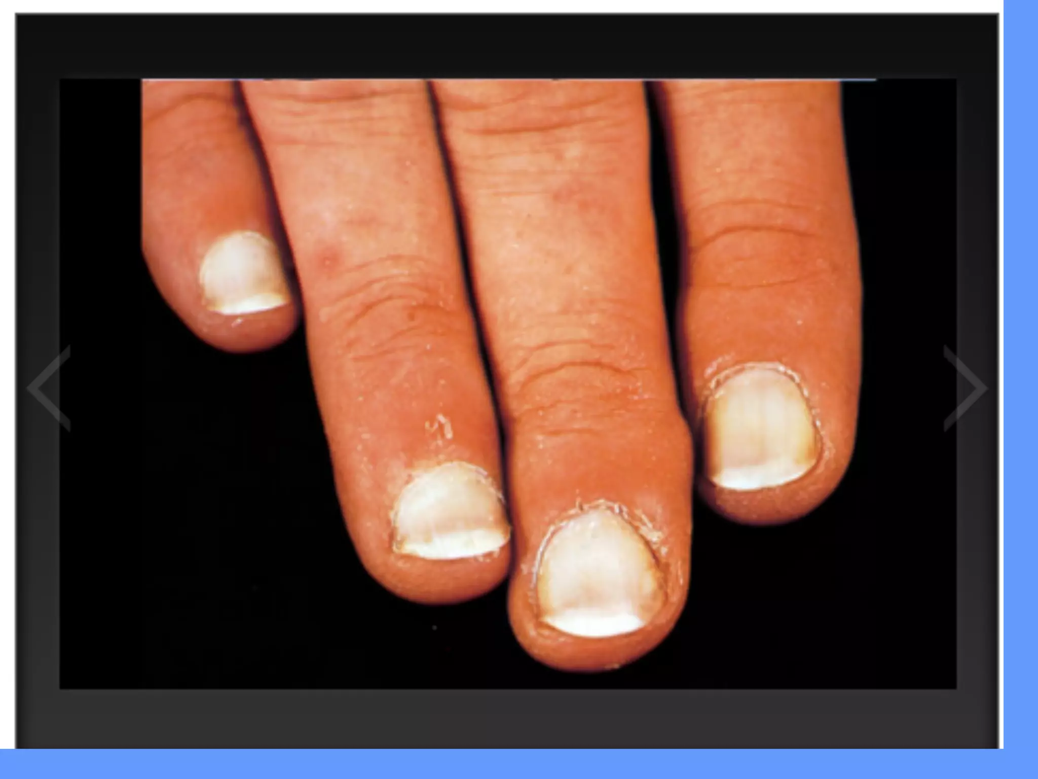 Nail disorder - Dr Aisha Almoosa | PDF | Skin and Dermatology ...