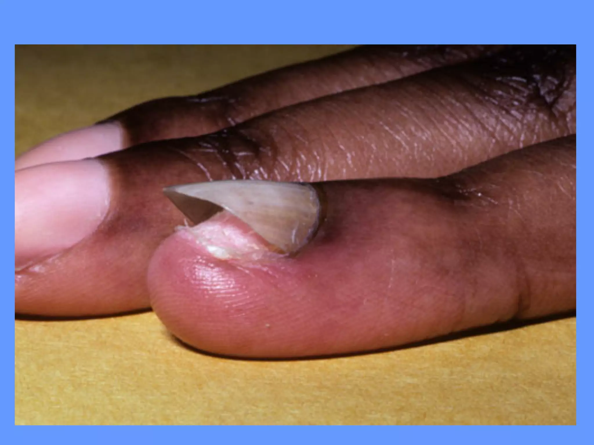 Nail disorder - Dr Aisha Almoosa | PDF | Skin and Dermatology ...