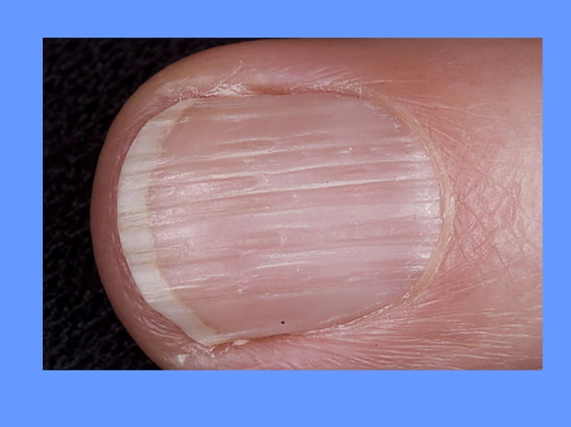 Nail disorder - Dr Aisha Almoosa | PDF | Skin and Dermatology ...
