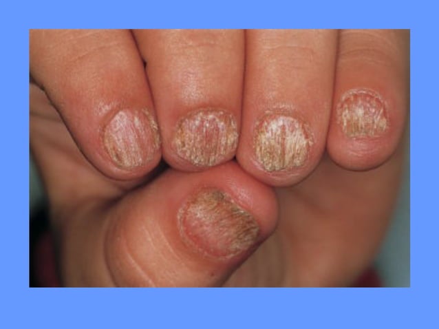 Nail disorder - Dr Aisha Almoosa | PDF | Skin and Dermatology ...