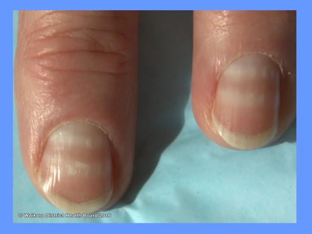 Nail disorder - Dr Aisha Almoosa | PDF | Skin and Dermatology ...