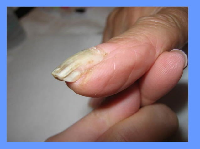 Nail disorder - Dr Aisha Almoosa | PDF | Skin and Dermatology ...