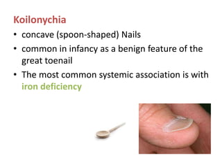 Nail disorder fahad albedaiwi | PPT