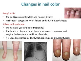 Nail disorder fahad albedaiwi | PPT