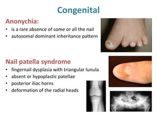 Nail disorder fahad albedaiwi | PPT