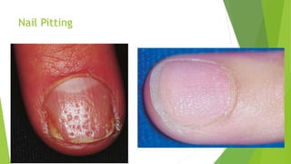 Nail disorders - Dr Ameen Alawadhi | PPTX