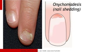 Nail Disorders Dr.mahar almorish dermatology.pptx