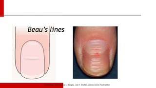Nail Disorders Dr.mahar almorish dermatology.pptx