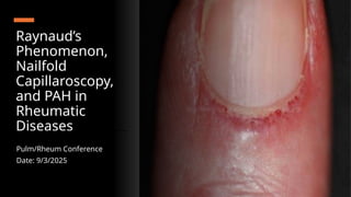 Nailfold Capillary Changes and Pulmonary hypertension | PPTX