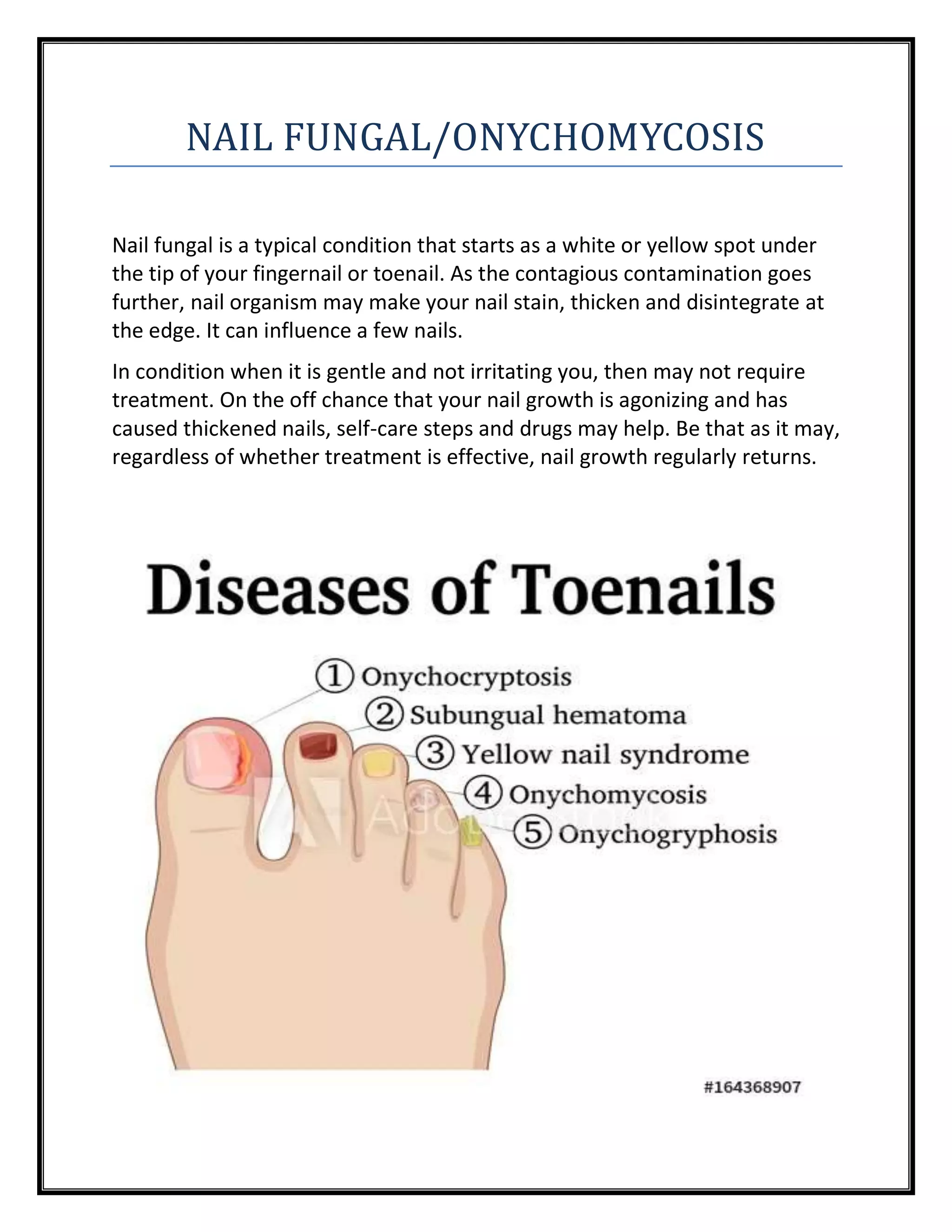 NAIL FUNGAL/ONYCHOMYCOSIS - Dr. Naval's Clinic | PDF