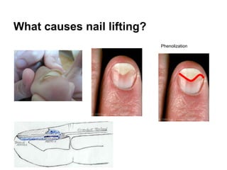 Nail injuries | PDF