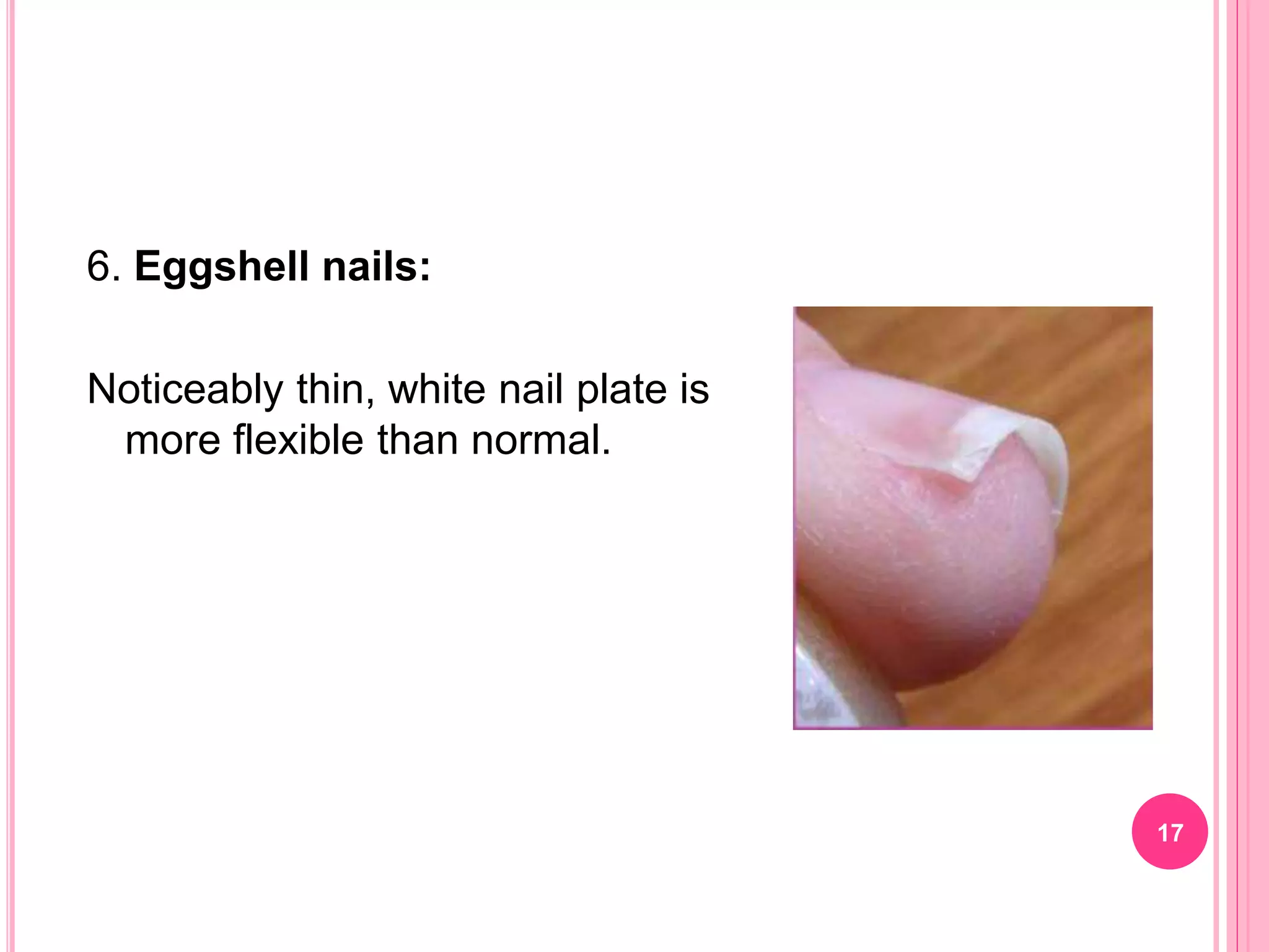 Diseases of nail and their treatment | PPTX