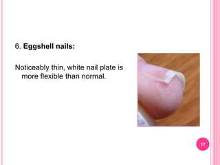 Diseases of nail and their treatment | PPTX