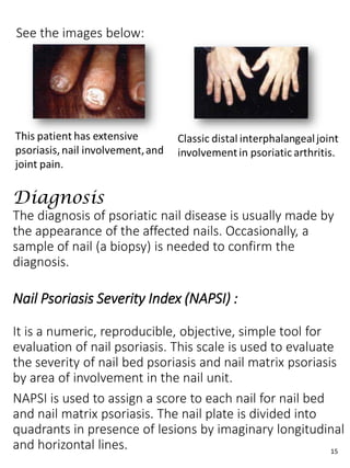 NAIL PSORIASIS | PDF