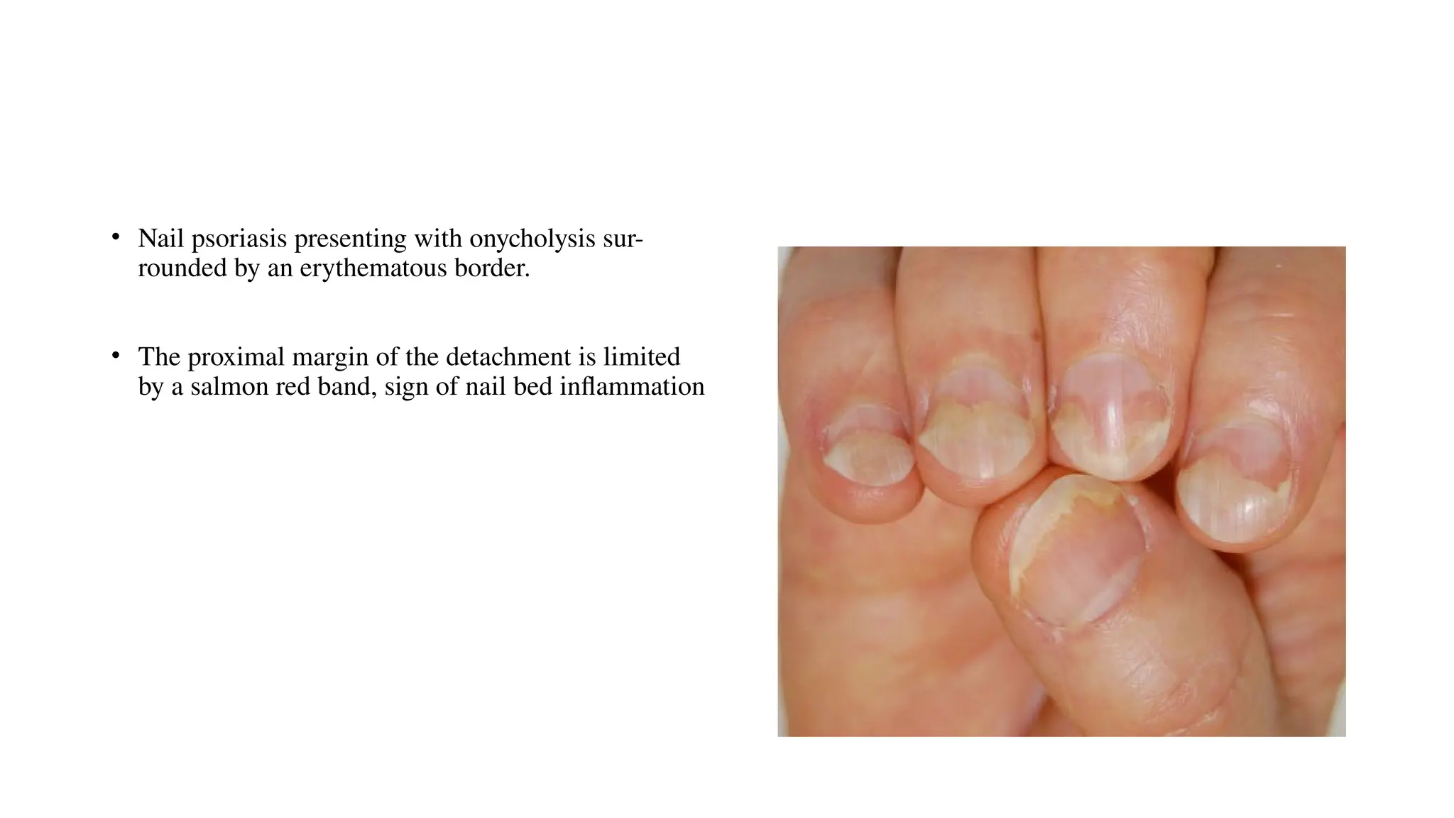 nail psoriasis is one of the manifestations of psoriasis | PPTX