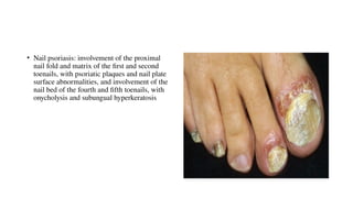 nail psoriasis is one of the manifestations of psoriasis | PPTX
