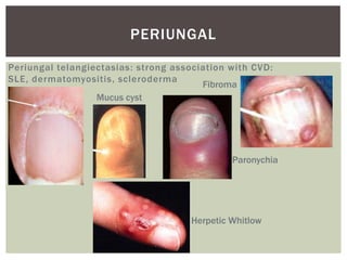 Periungual Telangiectasia