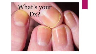 Nails on different disease conditions - images( medical information ...