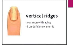 Nails on different disease conditions - images( medical information ) | PPT