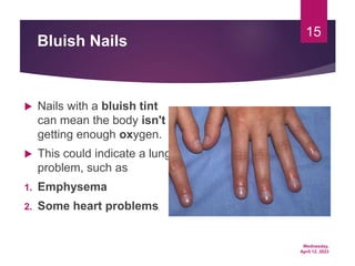 Nails in systemic diseases.ppt