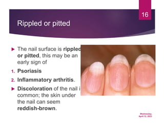 Nails in systemic diseases.ppt