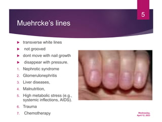 Nails in systemic diseases.ppt