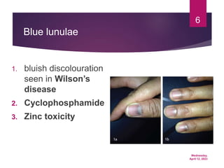 Nails in systemic diseases.ppt