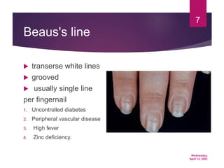 Nails in systemic diseases.ppt