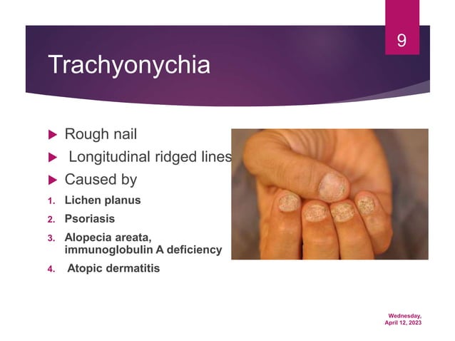 Nails in systemic diseases.ppt