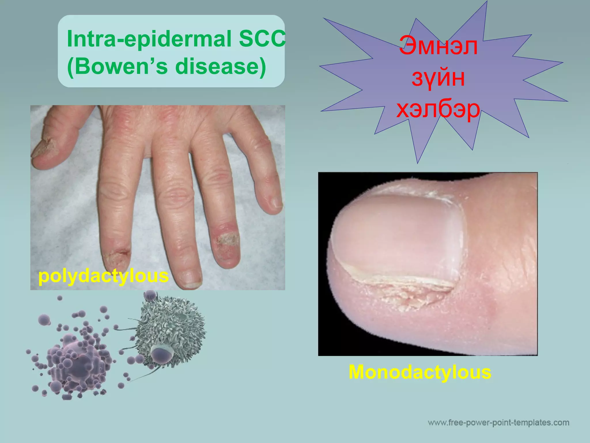 Nail tumor | PPT