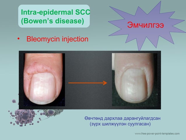 Nail tumor | PPT