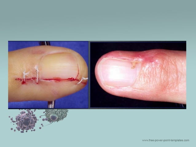 Nail tumor | PPT