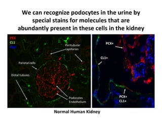 Fabry Disease Urinary Podocyte Loss - 14 February 2014 | PPT