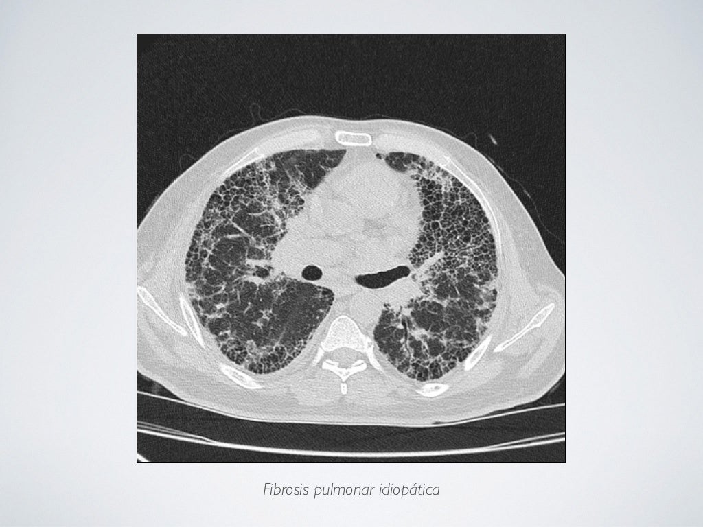 Enfermedad Pulmonares Intersticiales Difusas: Aproximación y Diagnóst…