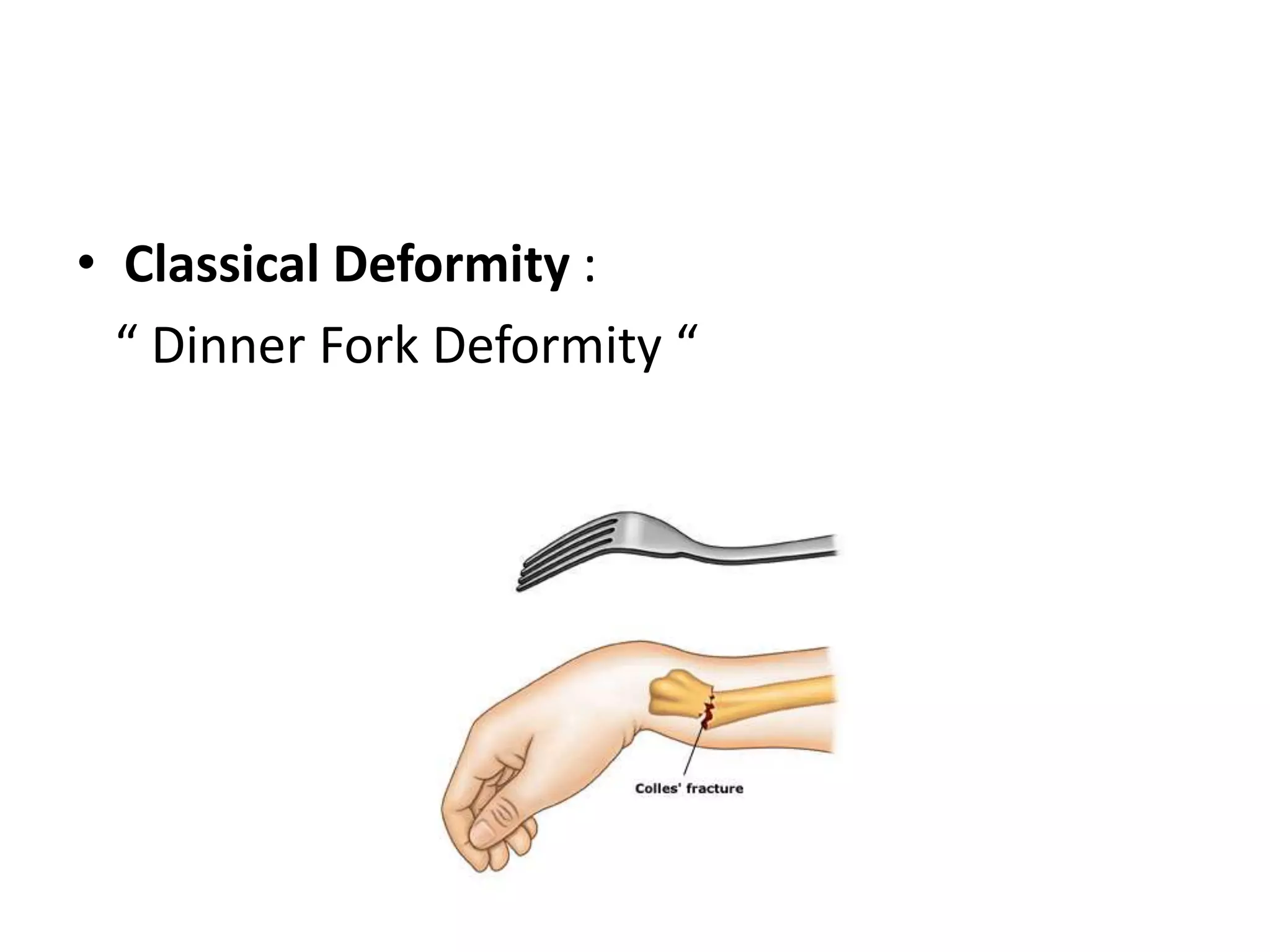 Named fractures of forearm ,wrist &and hand | PPTX