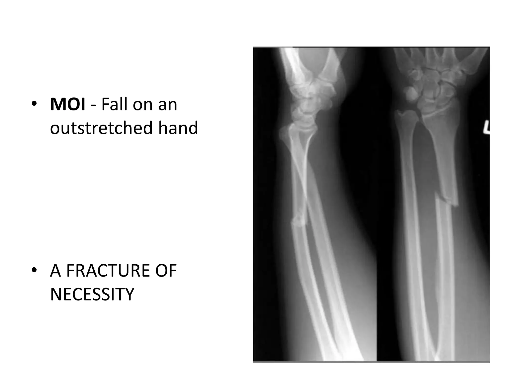 Named fractures of forearm ,wrist &and hand | PPTX