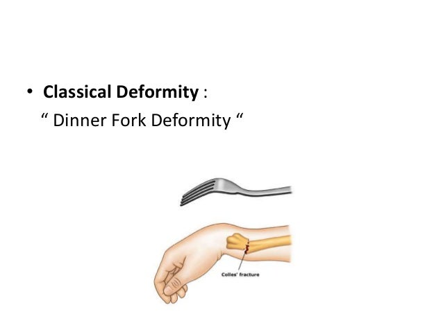 Named fractures of forearm ,wrist &and hand