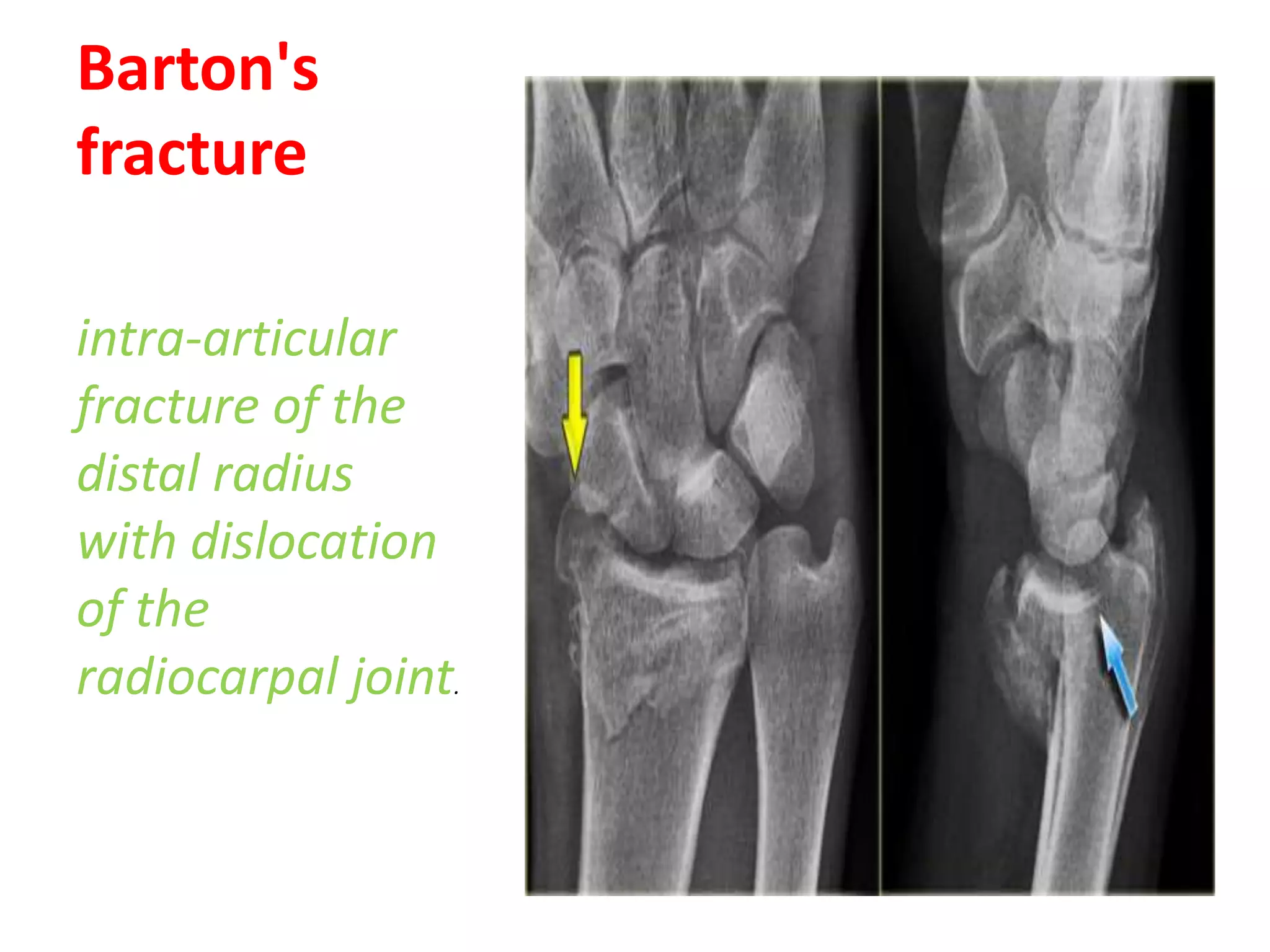 Name fractures | PPTX