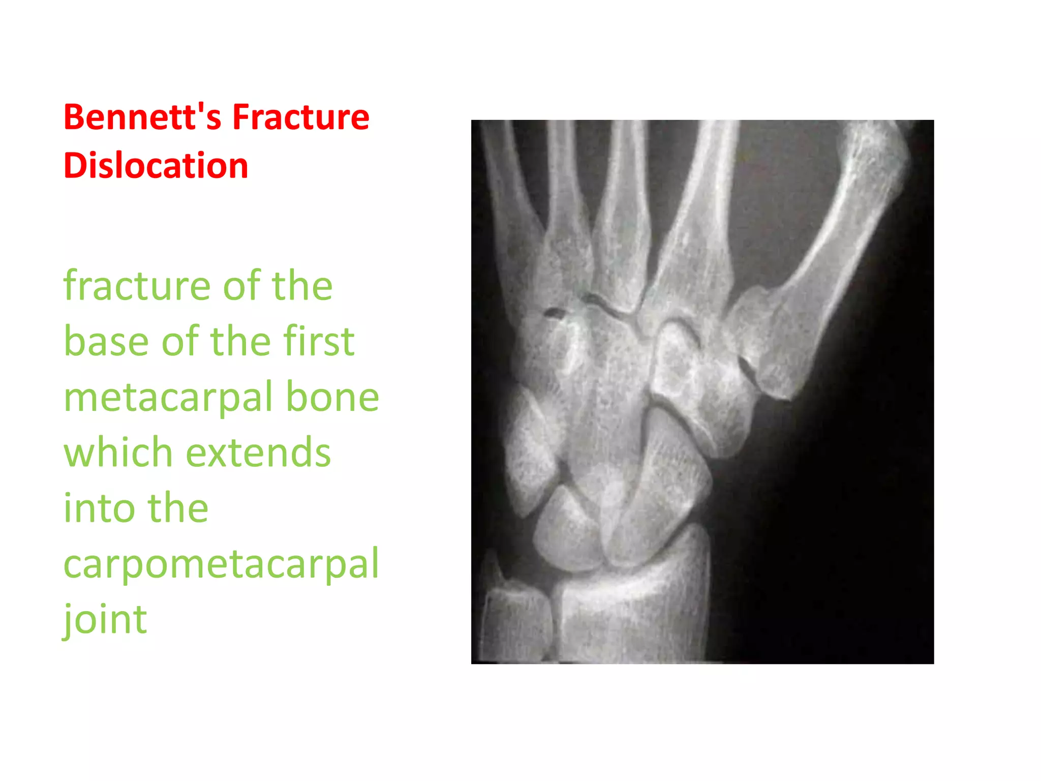 Name fractures | PPTX