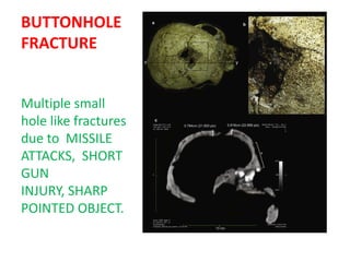 Name fractures | PPTX