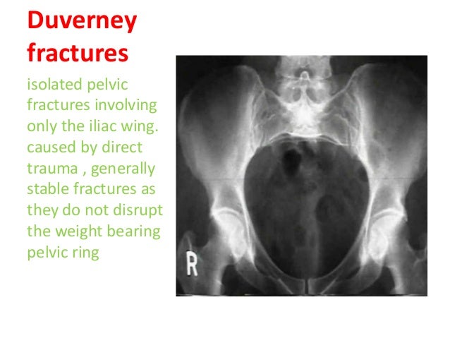 Duverney Fracture