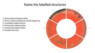 Name the labelled structures - Innocuous peripheral retinal ...
