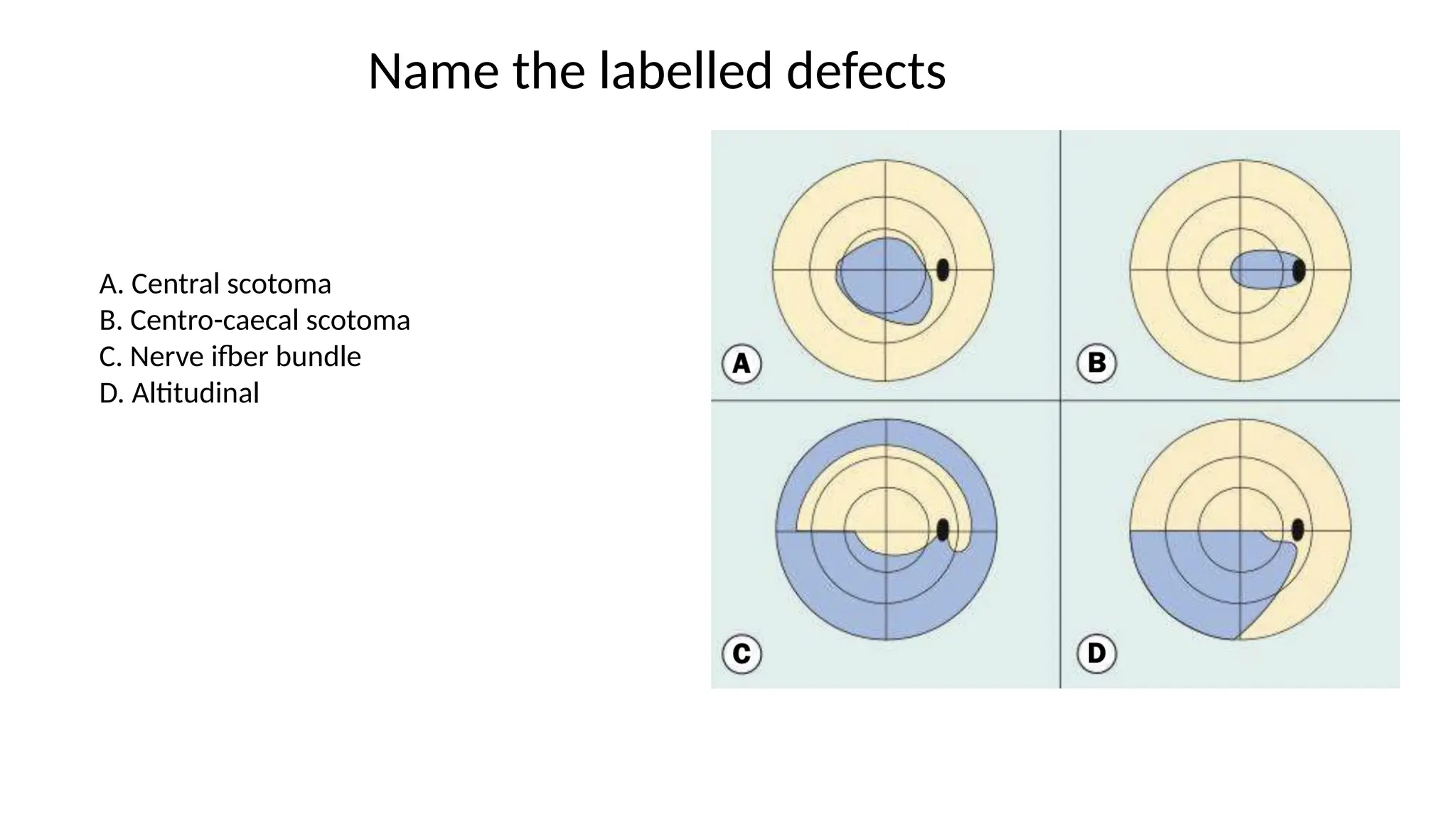Name the labelled VF defects - Visual Field defects in Optic Neuritis.pptx