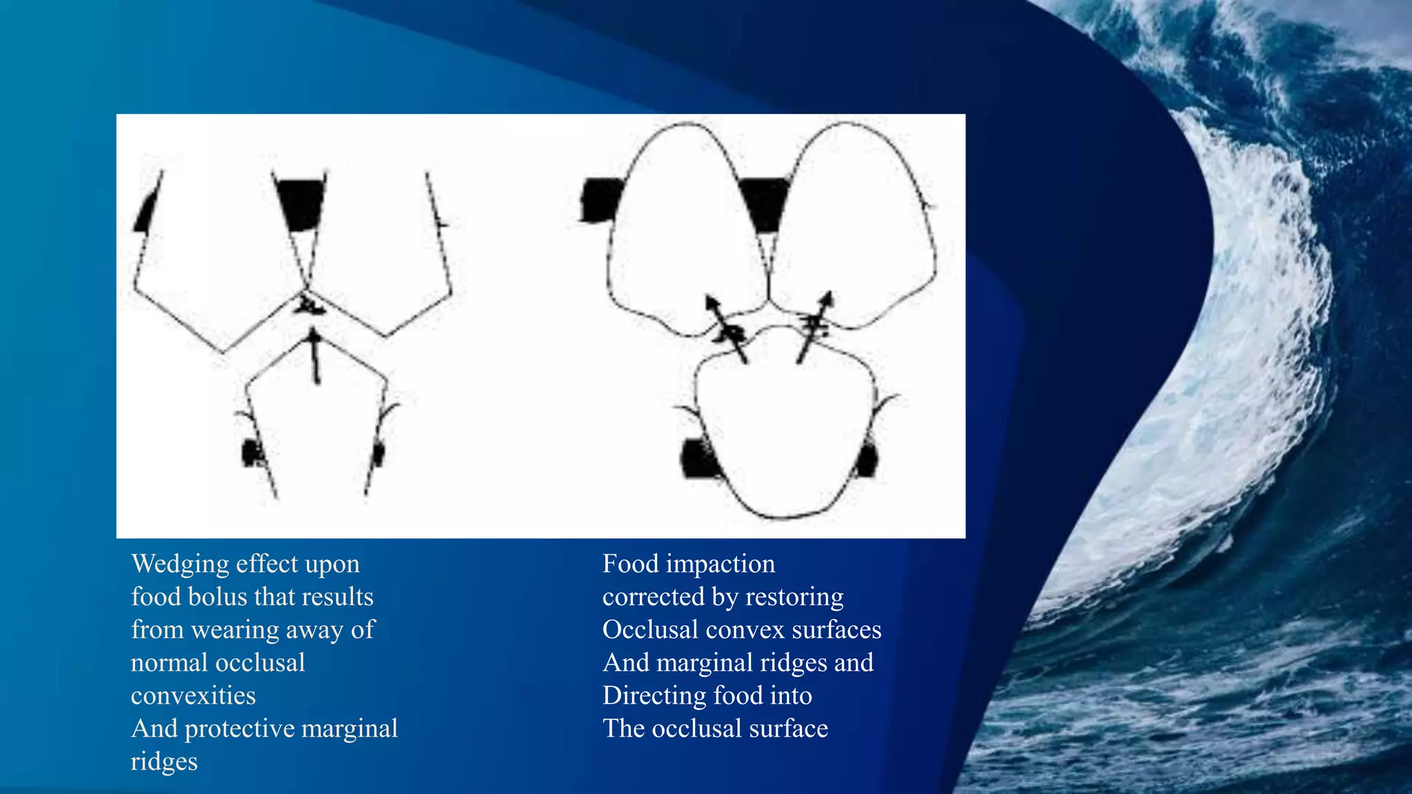 FOOD IMPACTION AND TREATMENT | PPTX