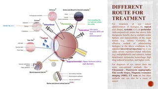 Nanocarrier based strategies for eye cancer management and | PPT